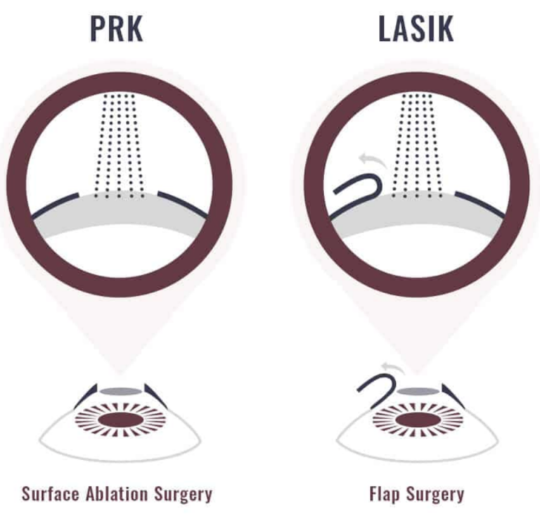 5 Facts You Need to Know About Smart Surface PRK at BoydVision